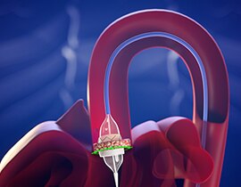 VALVE ASSIST| GE HealthCare