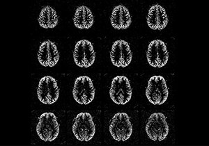 3D ASL| GE HealthCare